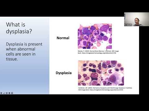 MDS and New Treatment Options - Dr. Jenny Ho