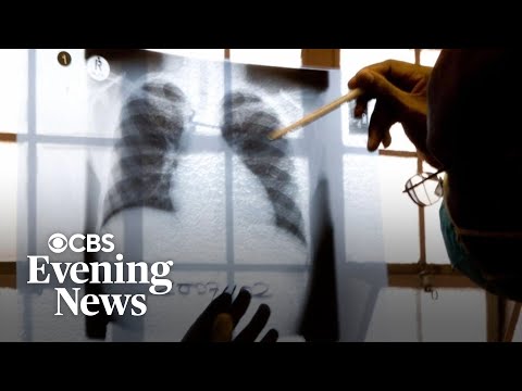 Author John Green explains why "Everything Is Tuberculosis"