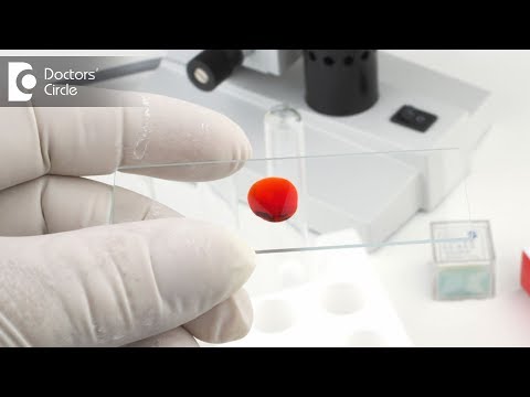What tests are done when Iron Deficiency Anaemia is suspected?- Dr. Cajetan Tellis