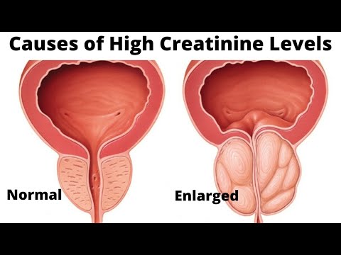 Causes of High Creatinine Levels