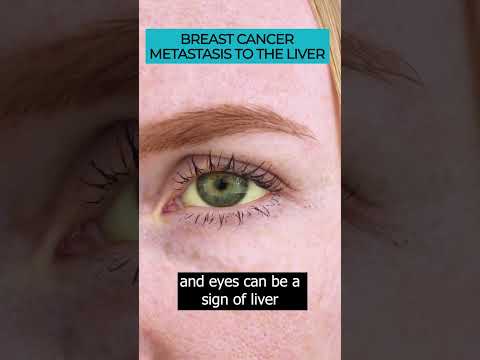 Identifying Symptoms of Breast Cancer Metastasis to the Liver ๐๏ธ#Cancer #Metastasis #LiverMetastasis