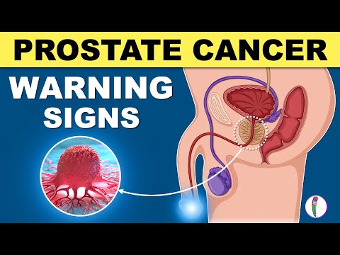 Prostate Cancer Signs | Warning Signs of Prostate Cancer