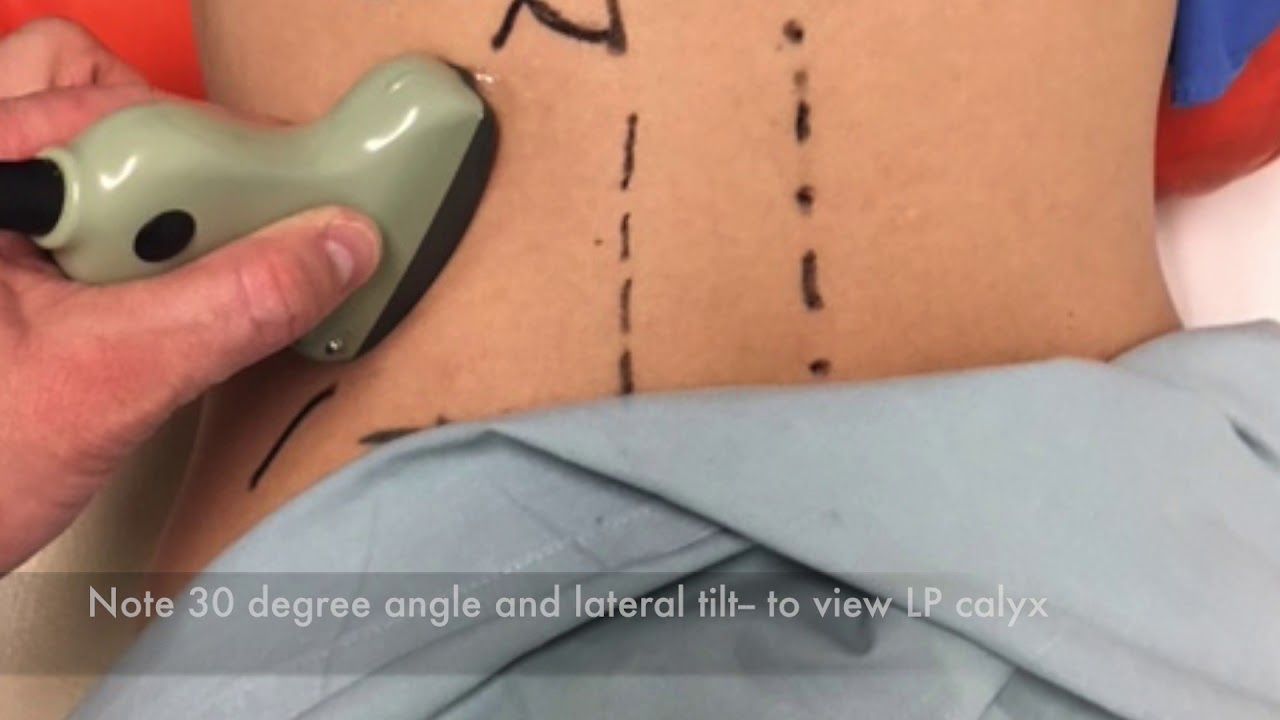 Ultrasound-guided PCNL access