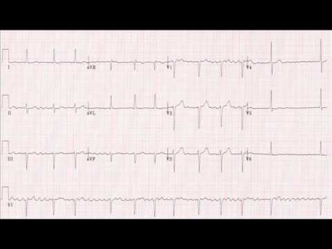Atrial or ventricular ECG/EKG..?