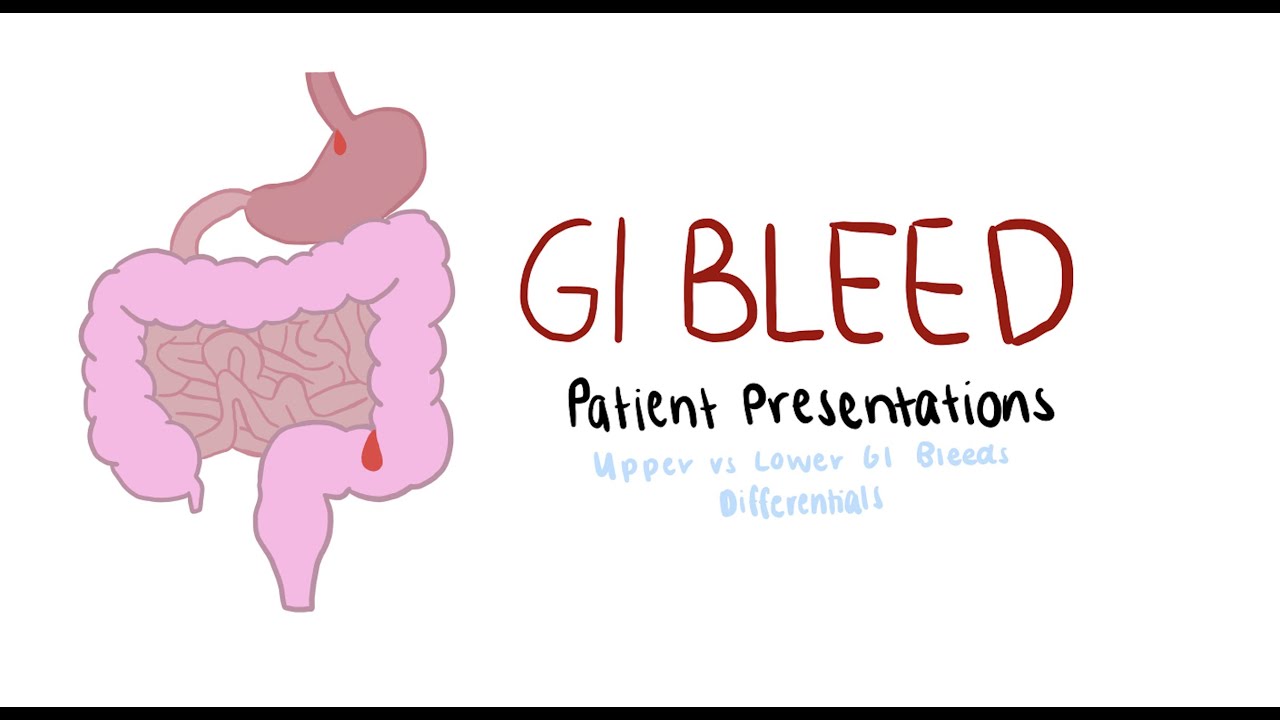 GI Bleed (Presentation, Upper vs Lower Bleeds and Differentials)