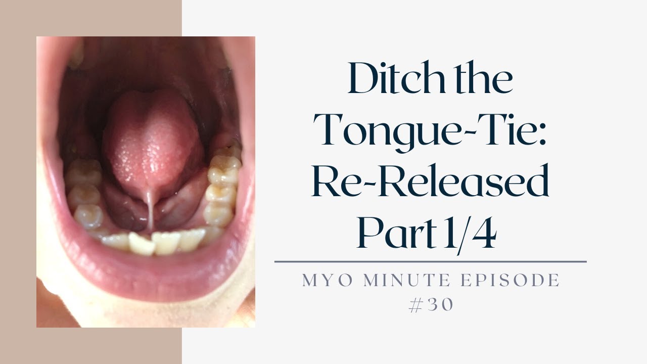 Ditch the Tongue Tie: Part 1