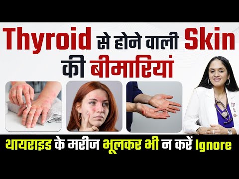 थायराइड की कमी से होने वाली त्वचा समस्याएं |Hypothyroidism/Hyperthyroidism से होने वाली Skin Disease