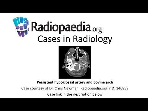 Persistent hypoglossal artery and bovine arch (Radiopaedia.org) Cases in Radiology