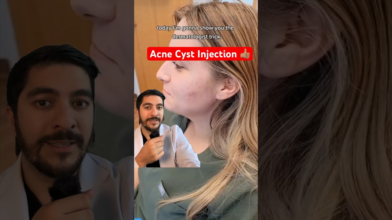 Fastest Way To Treat Acne Cyst
