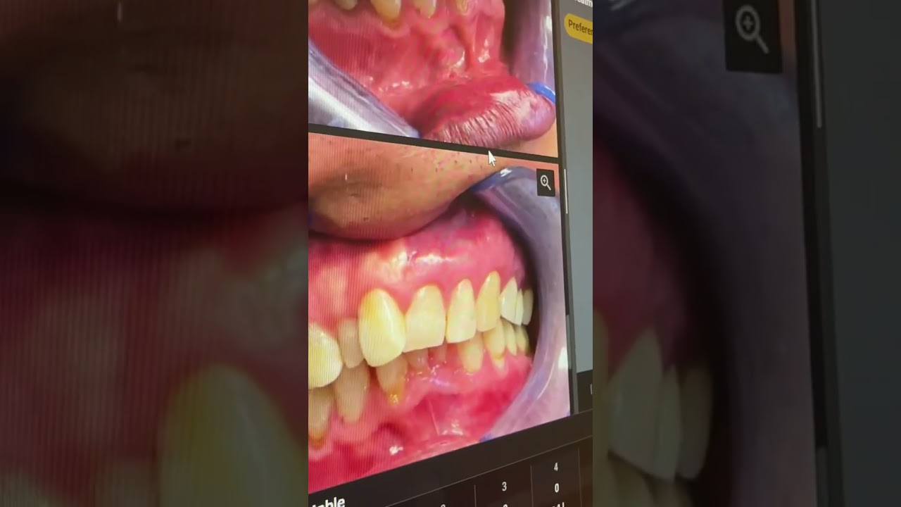Severe Crowding Transformed with Invisalign | Gentle Dentistry of Poway