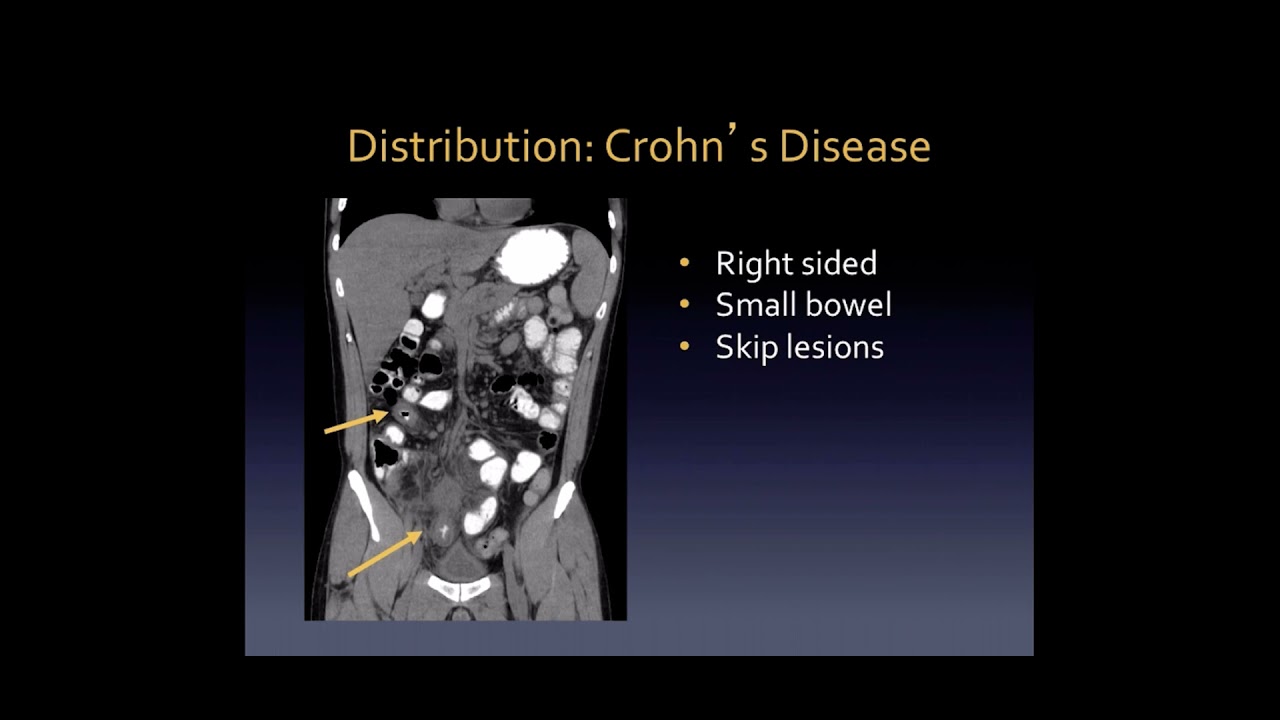 CT evaluation of colitis