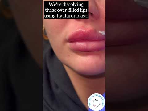 Dissolving Migrated Lip Filler!