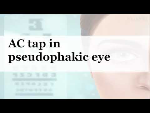 AC tap in pseudophakic eye