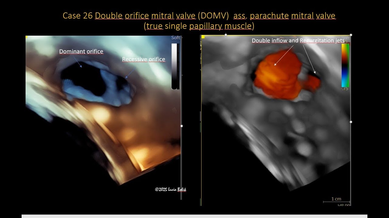 Case 26 Double orifice mitral valve associated with parachute mitral valve