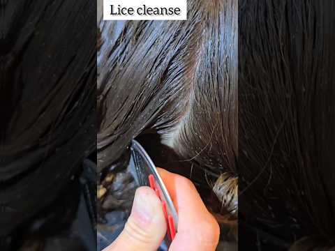 How to get rid of lice from hair permanently | lice removal comb #antihall #licecomb