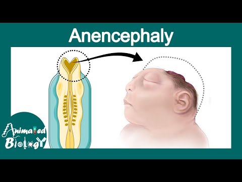 Anencephaly | Neural tube defects | folate deficiency | USMLE