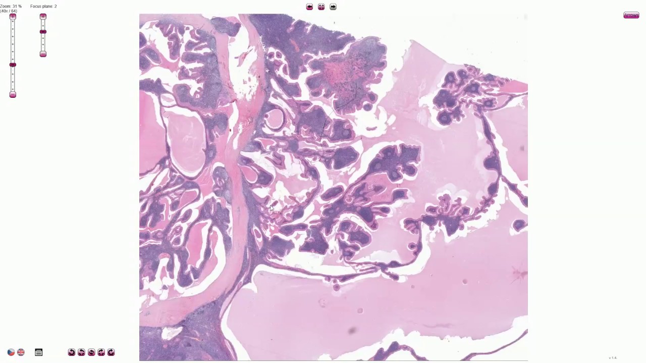 Warthin Tumor - Histopathology