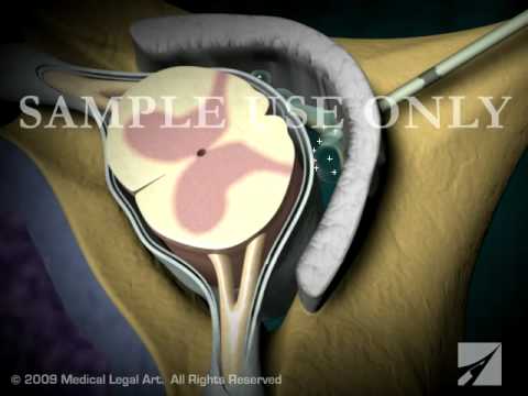 Cervical Epidural Steroid Injection