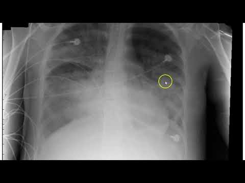 Acute Respiratory #3: ARF, ARDS, PE