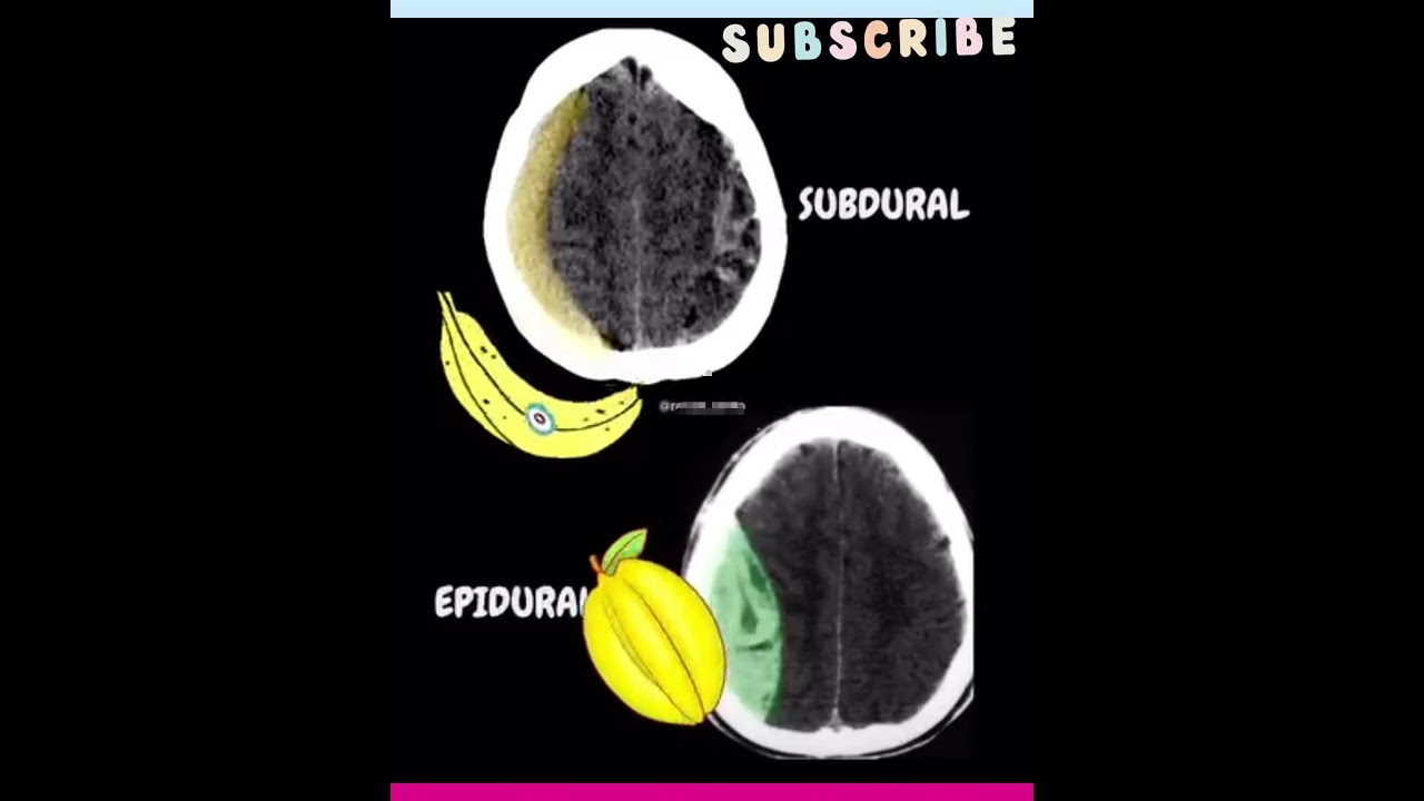 Subdural Hemorrhage (SDH) & Epidural Hemorrhage (EDH) #radiographer #paramedical #viralvideo