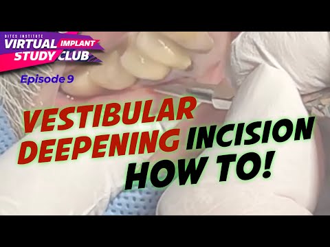 VSC E9 "Vestibular Deepening Incision - How to!"