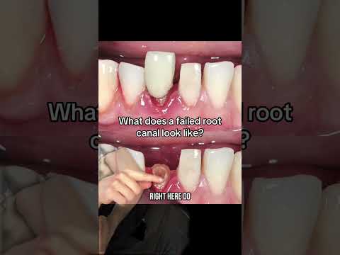 What Does a Failed Root Canal Look Like?