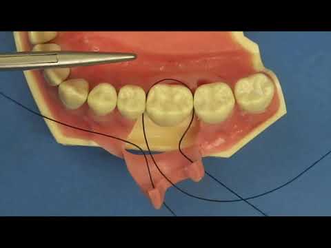 Single Sling Buccal Approach