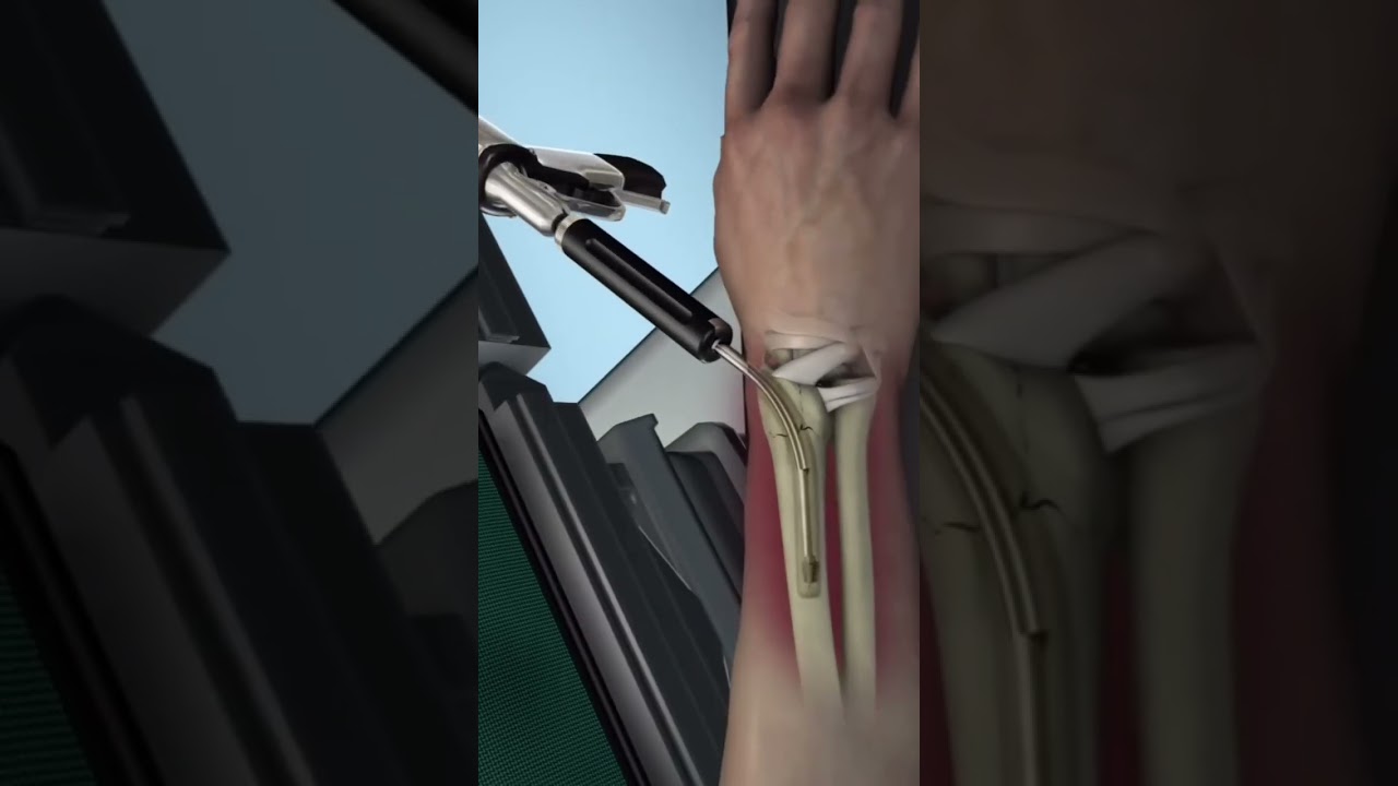 La reparación de fracturas óseas busca devolver al hueso su alineación y función normal.