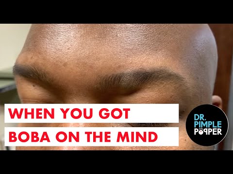 Dr. Pimple Popper Pops 'Black Pearl' Eyebrow Tumor In Youtube Videos