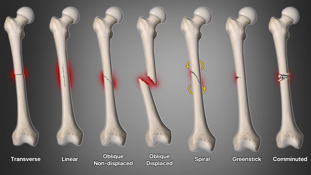 Long Bone Fractures: Explained! (+ X-Ray Examples)