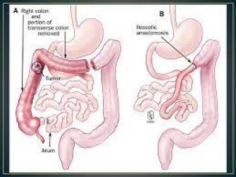 Enterectomy CPT code - simplify medical coding