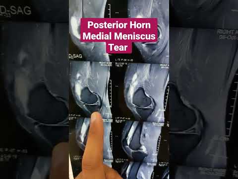 Posterior Horn Medial Meniscus Tear ..Dr Sai Chandra