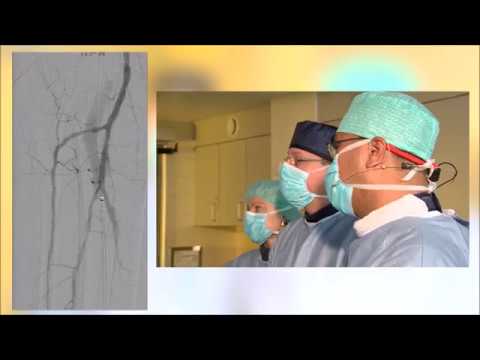 Venous arterialisation for no option CLI: Limflow procedure – Vascupedia