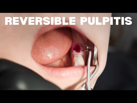 Reversible & Irreversible Pulpitis | Apexification