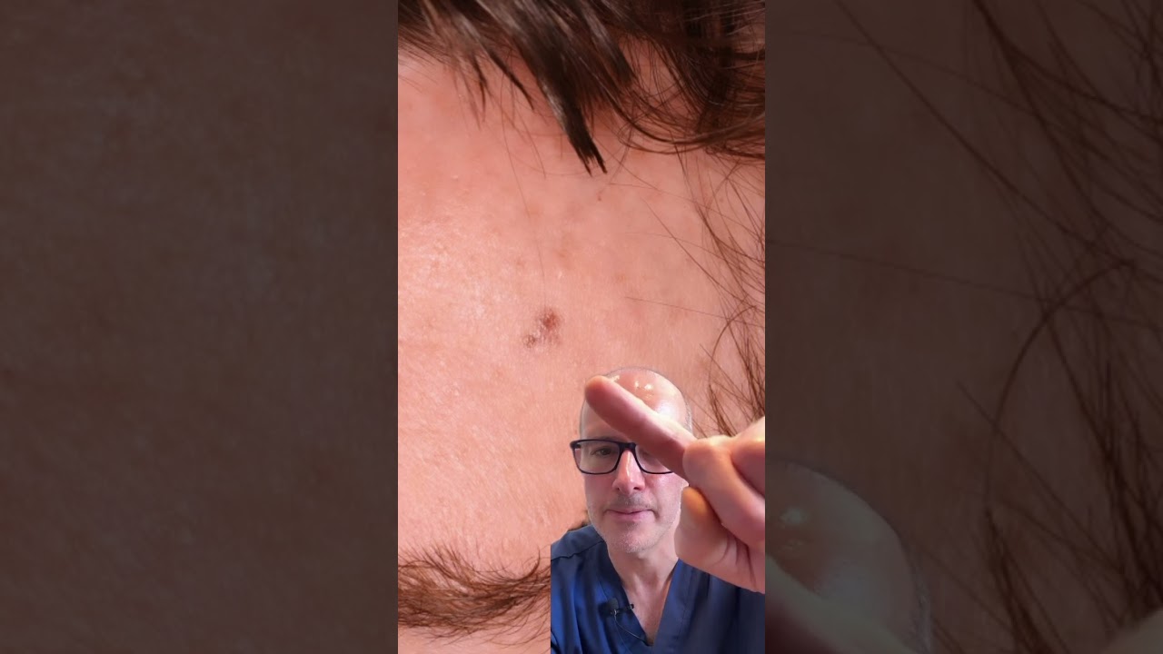 Early Stage Melanoma: A Life-Saving Detection
