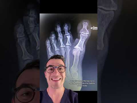 Hallux Varus Deformity
