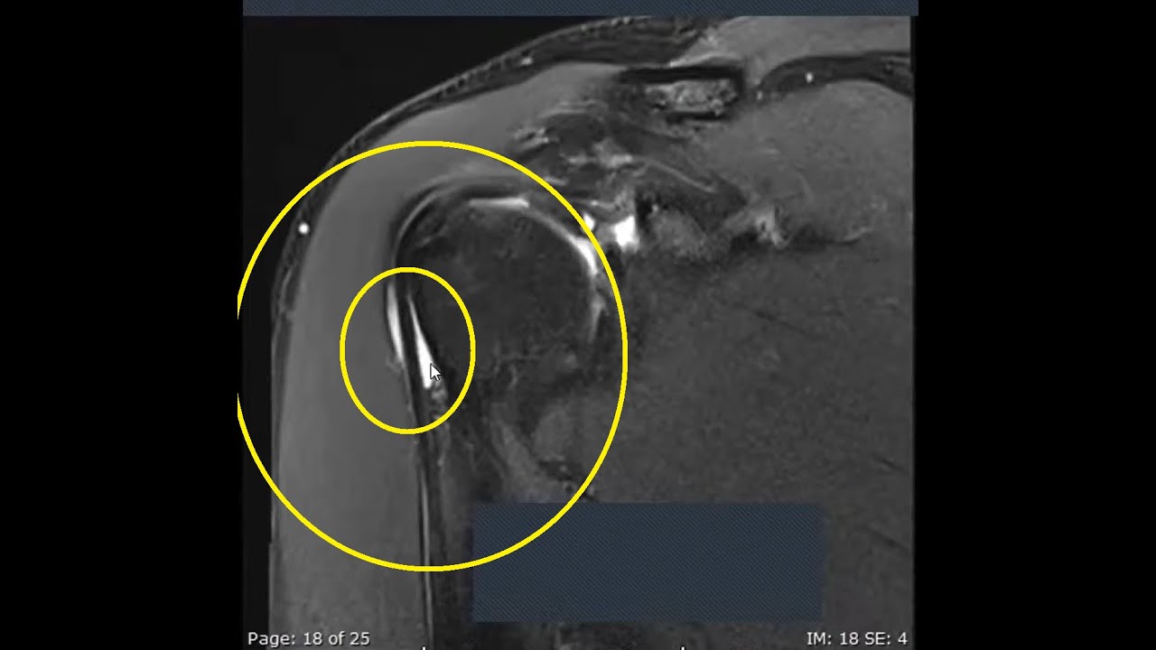 Shoulder MRI Made Easy