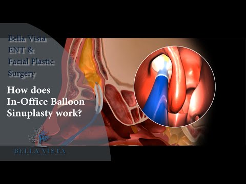 Sinus Procedure In-Office - Balloon Sinuplasty