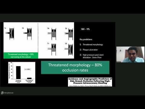 ICAD Stenting - in stent re-stenosis and occlusion?