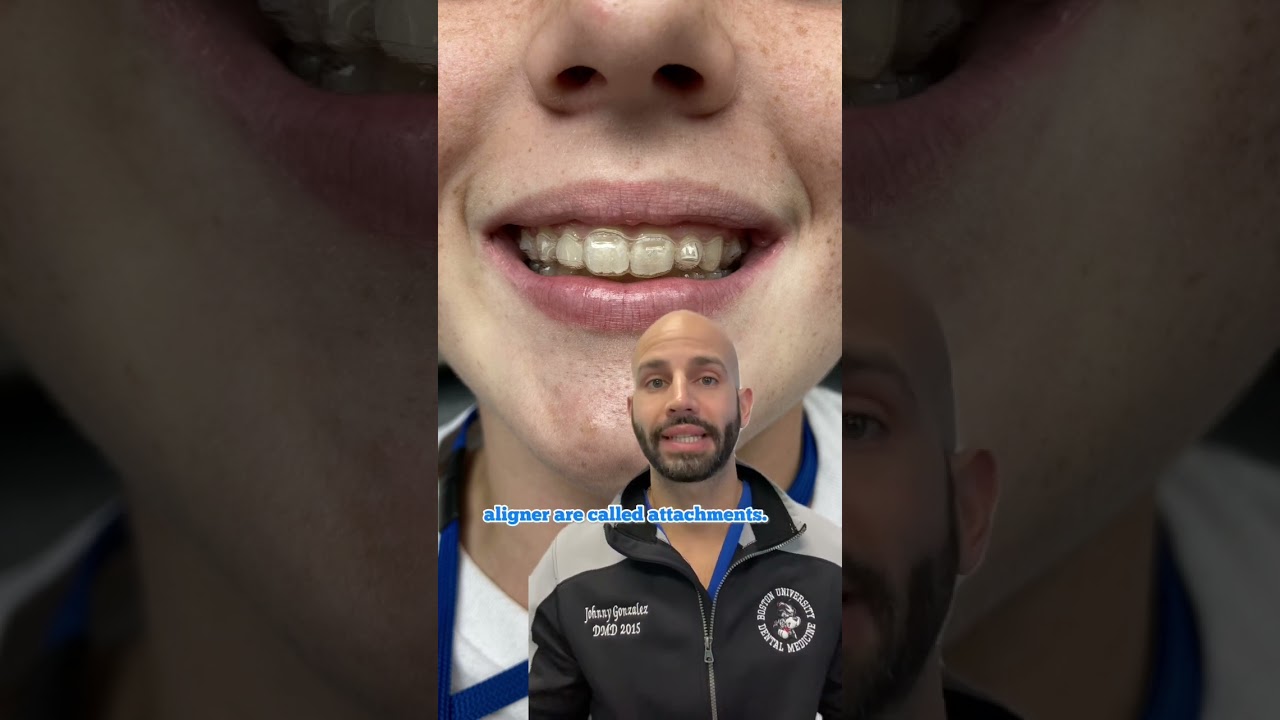 Invisalign versus braces and tooth-colored attachments explained!