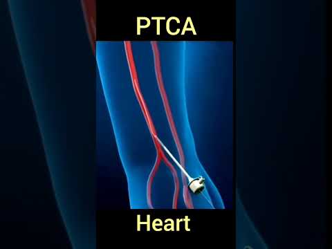 Percutaneous transluminal coronary angioplasty#heart surgery #nurse #exam #video