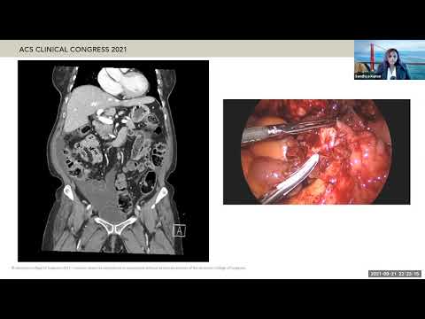 Appendicitis Optimal Treatment of Unexpected Pathology