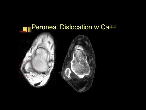 Ankle Tendons - Pt 1
