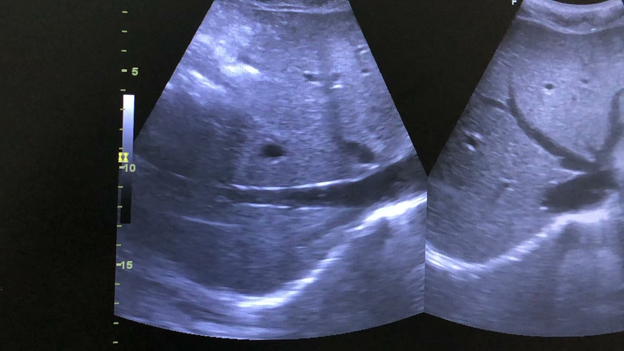 Acute kidney injury with fascia of gerota