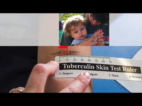 Diagnosing Latent TB Infection (LTBI)