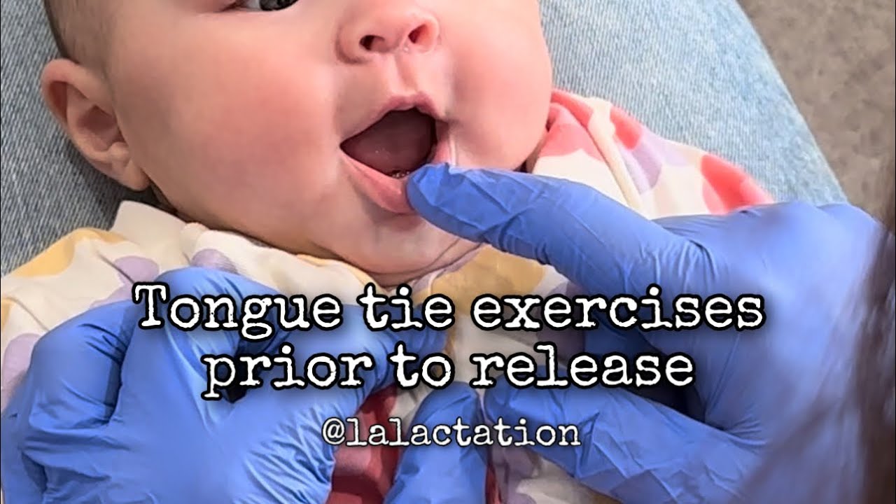 Infant tongue exercises prior to tongue and lip tie release