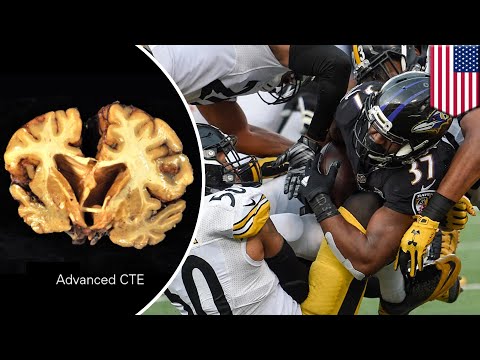 Brain disease CTE found in 99% of NFL players, latest brain study shows - TomoNews