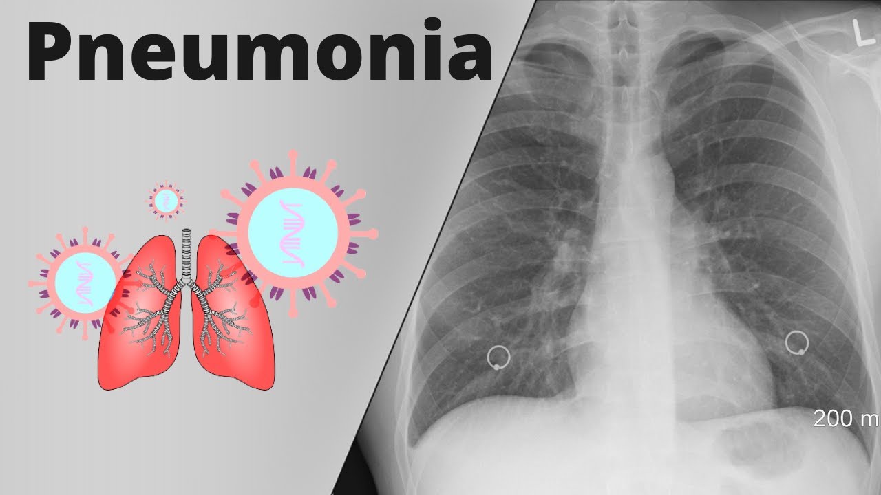 Pneumonia - Overview