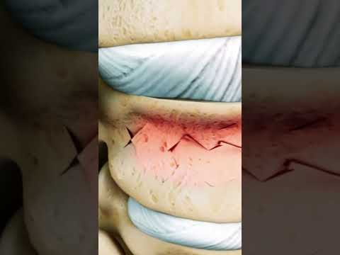 What are the Goals of a Kyphoplasty Procedure?