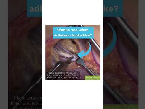 Here’s what adhesion or fibrosis looks like around the metal tool that causes chronic pain